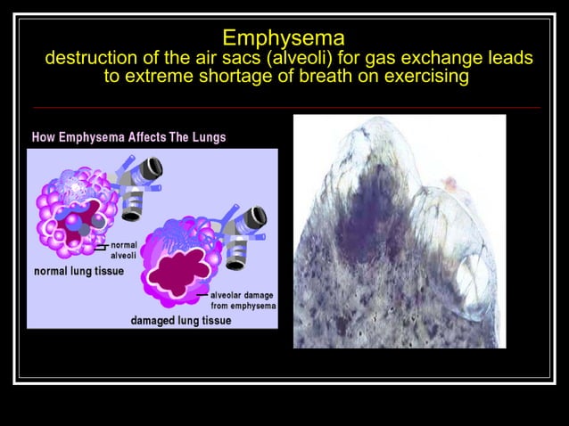 Grade 11 - Gas Exchange and Smoking | PPT