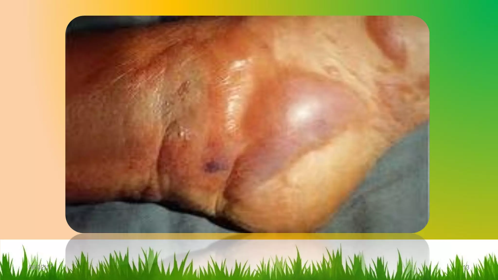 Gas gangrene | PPT