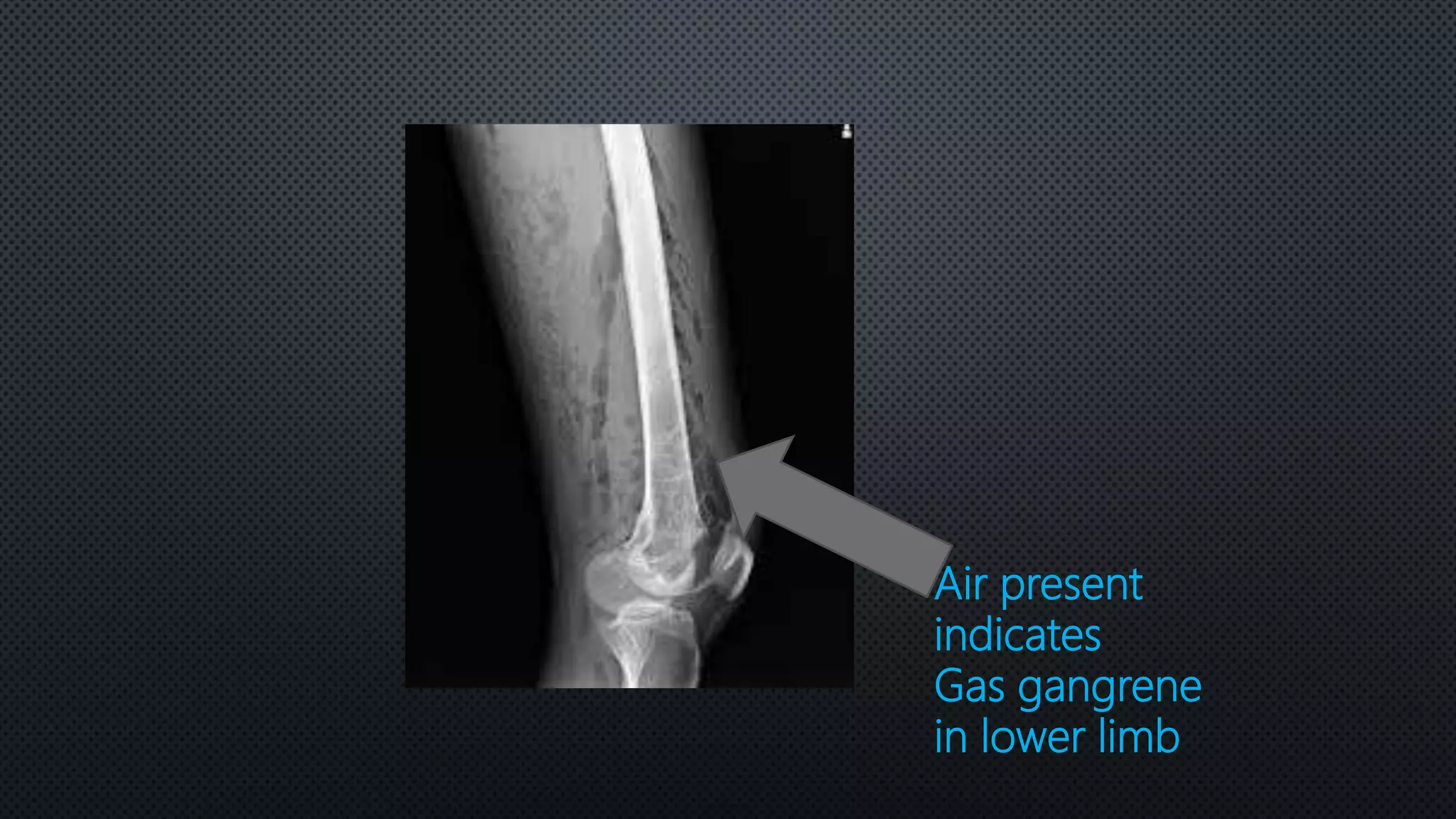 Gas gangrene | PPTX
