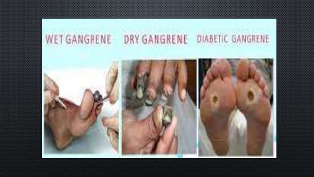 Gas gangrene | PPTX