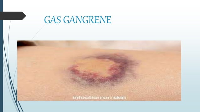 Gas Gangrene.pptx