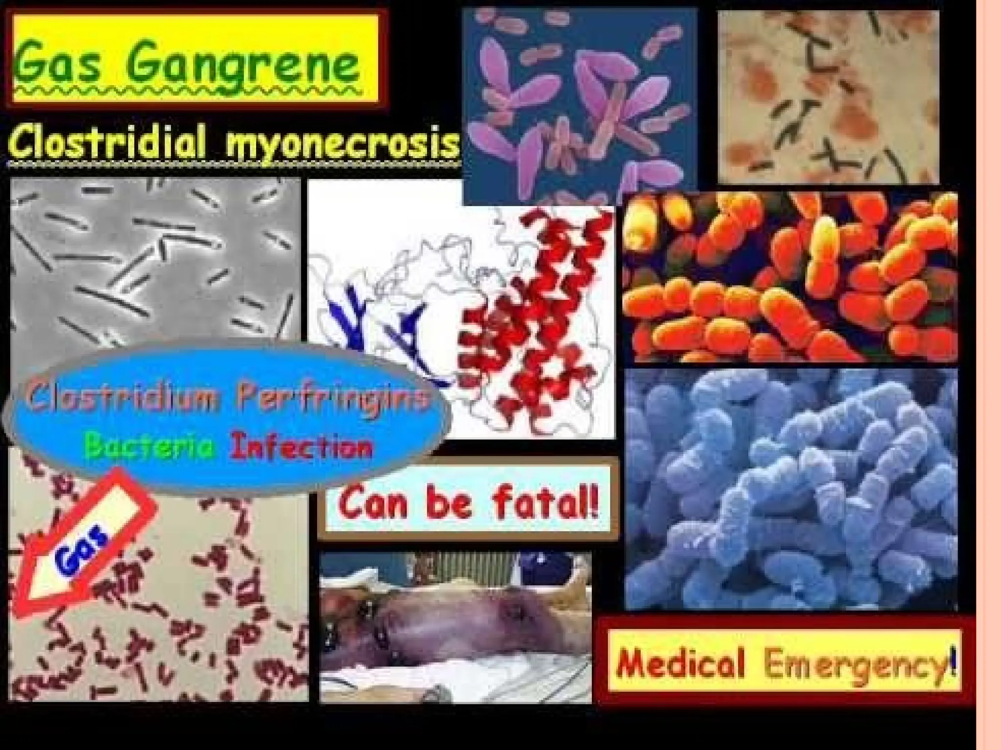 Gas Gangrene & SCOPE OF HOMOEOPATHIC MANAGEMENT | PPT