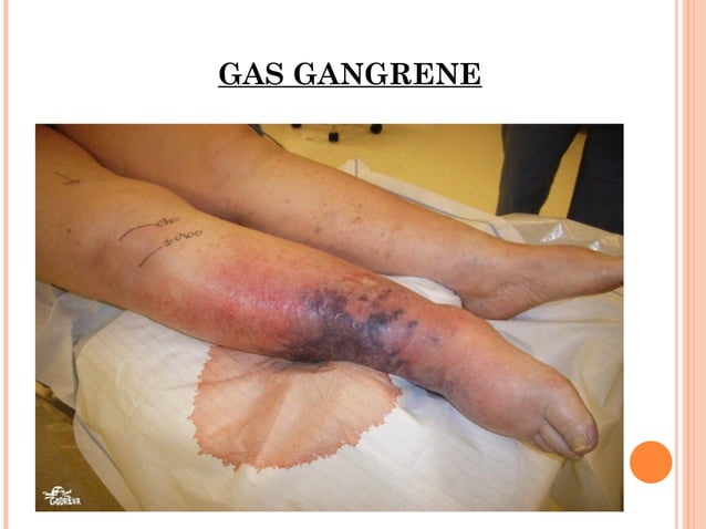 Gas Gangrene Scope Of Homoeopathic Management Ppt