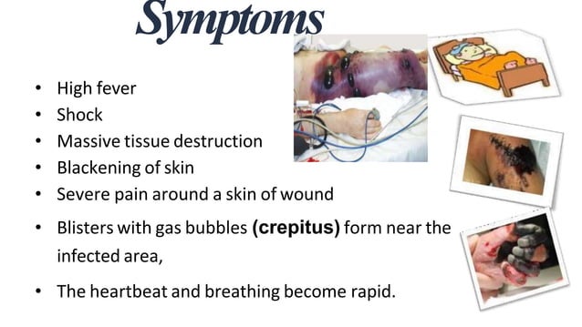 Gas gangrene dr bhavika(pathogenies,clinical features and lab diagnosis ...