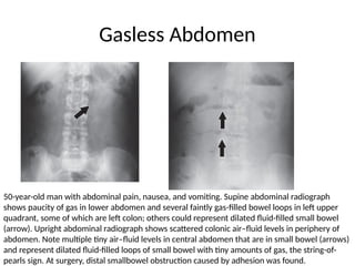Gasless Abdomen and displaced bowel.pptx