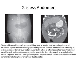Gasless Abdomen and displaced bowel.pptx