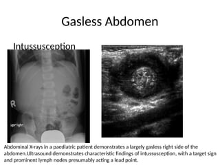 Gasless Abdomen and displaced bowel.pptx