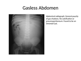 Gasless Abdomen and displaced bowel.pptx