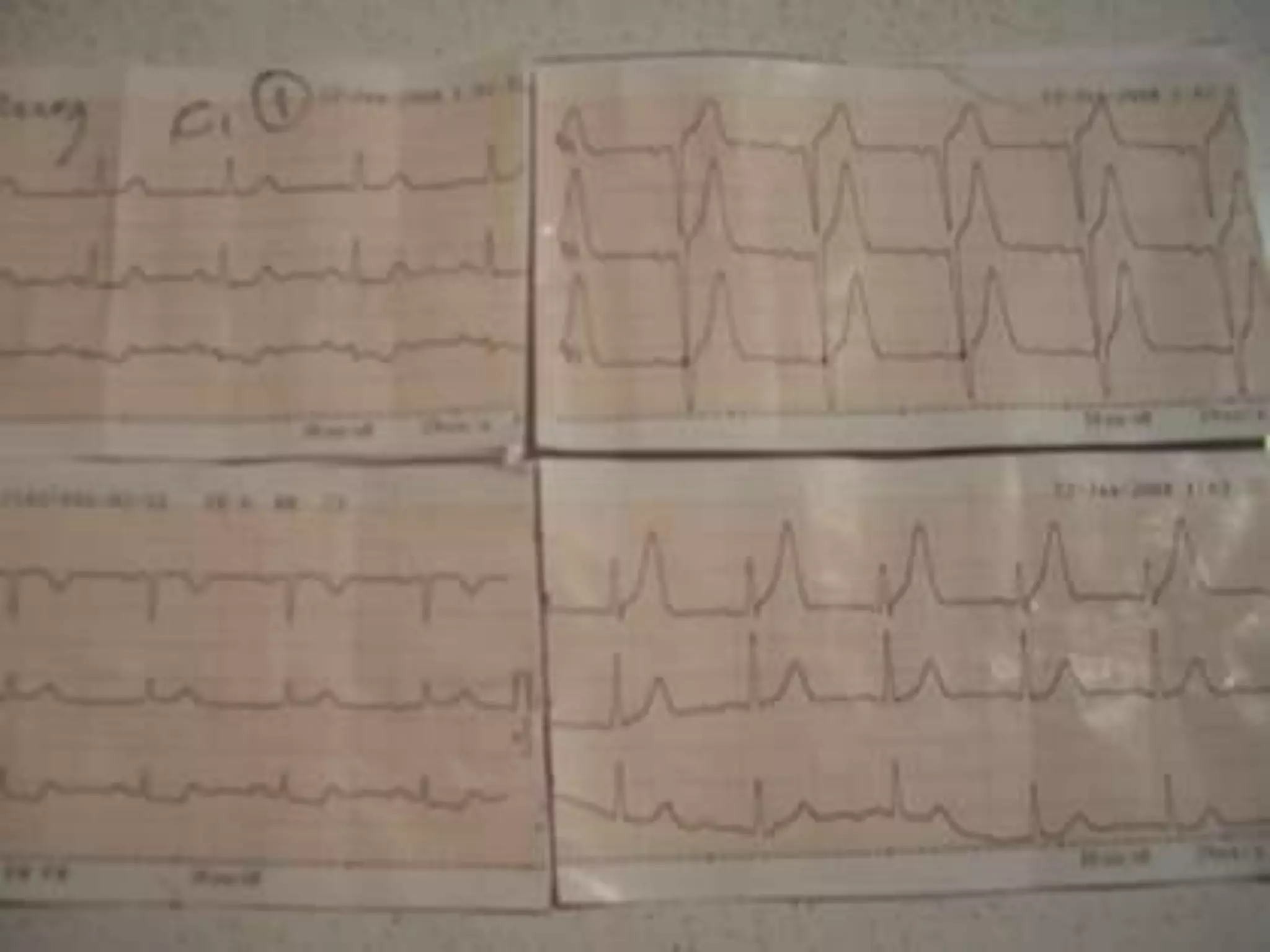 Gasometria arterial pulsioximetria_cooximetria | PPT