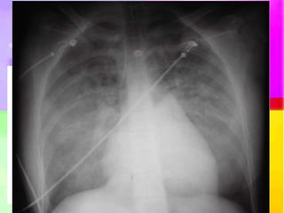 Gasometria arterial pulsioximetria_cooximetria | PPT