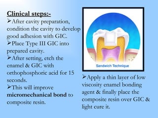 Gass Ionomer Cement | PPT