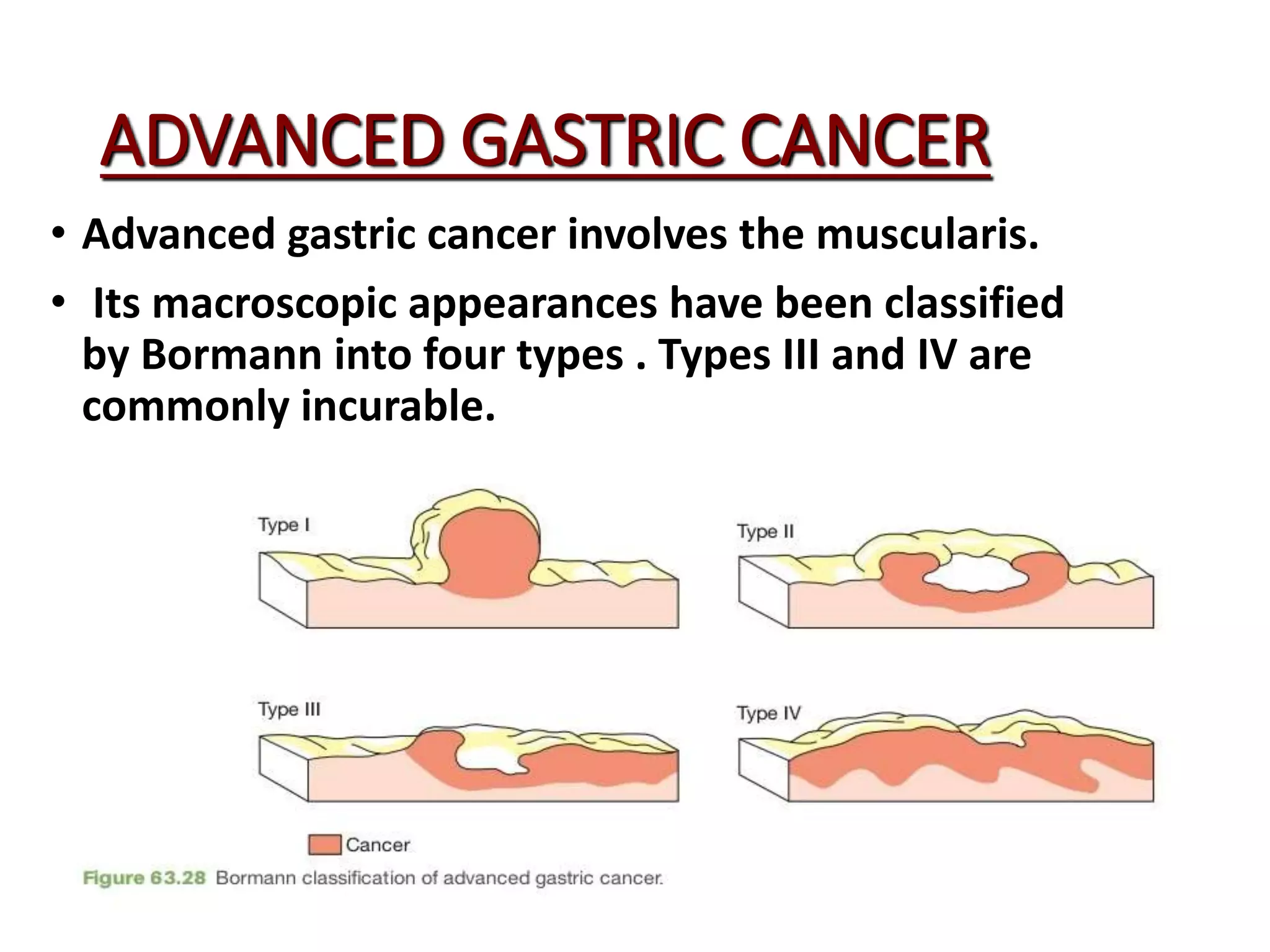 gastic carcinoma-1.pptx