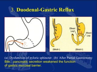 Gastitis,treatment, symptoms, 4042024.ppt