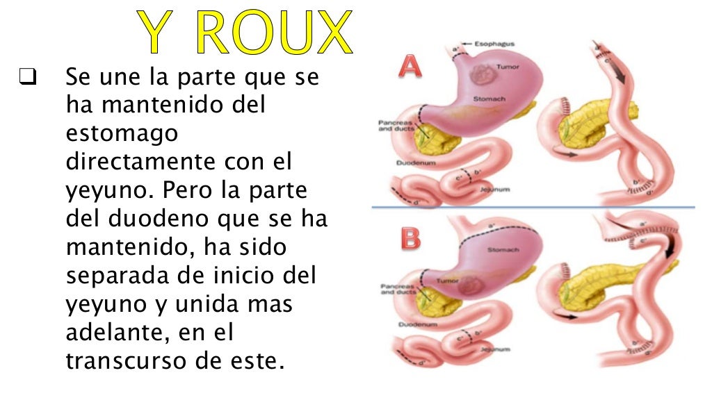 Gastrectomia billroth 1 y 2