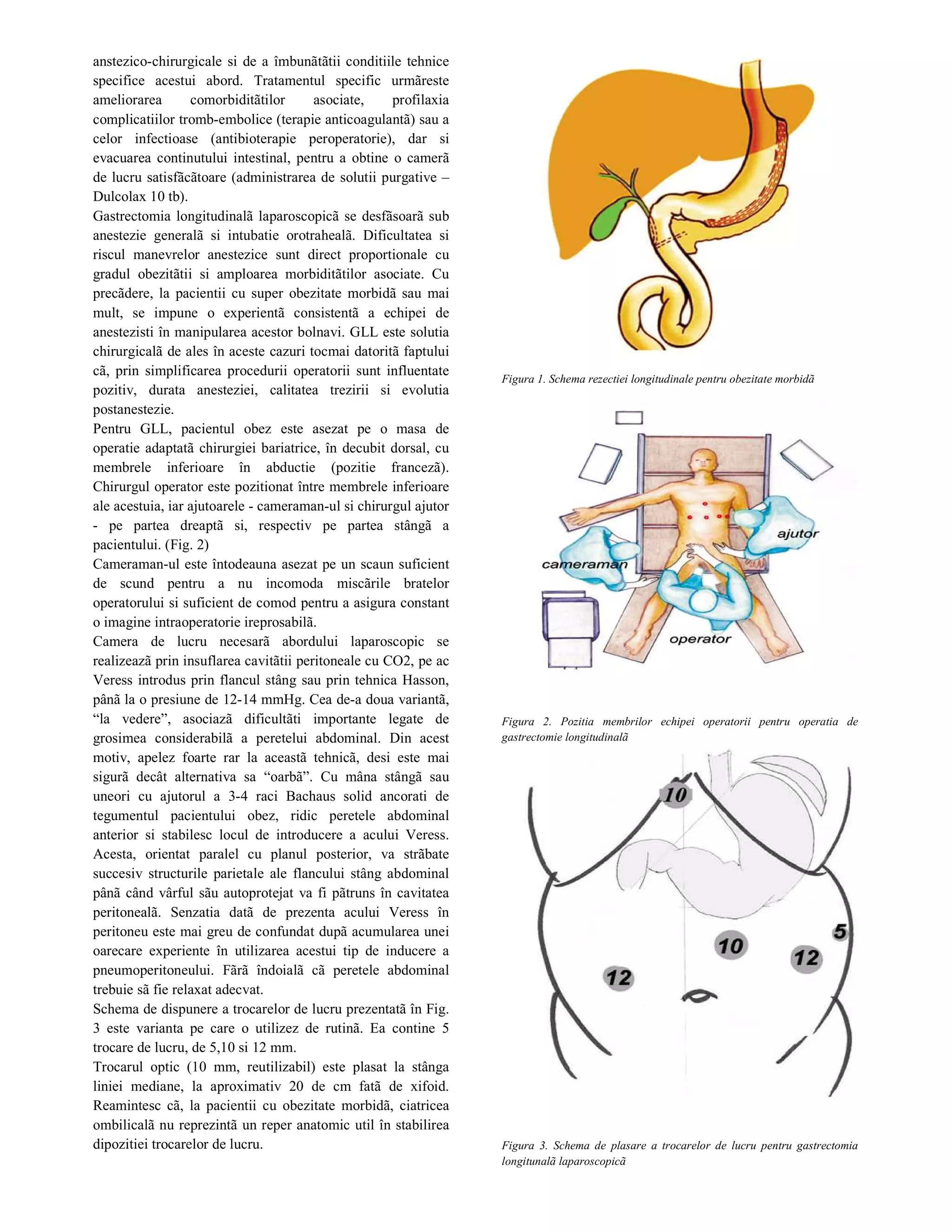 Gastrectomia longitudinala pentru tratamentul obezitatii morbide | PDF