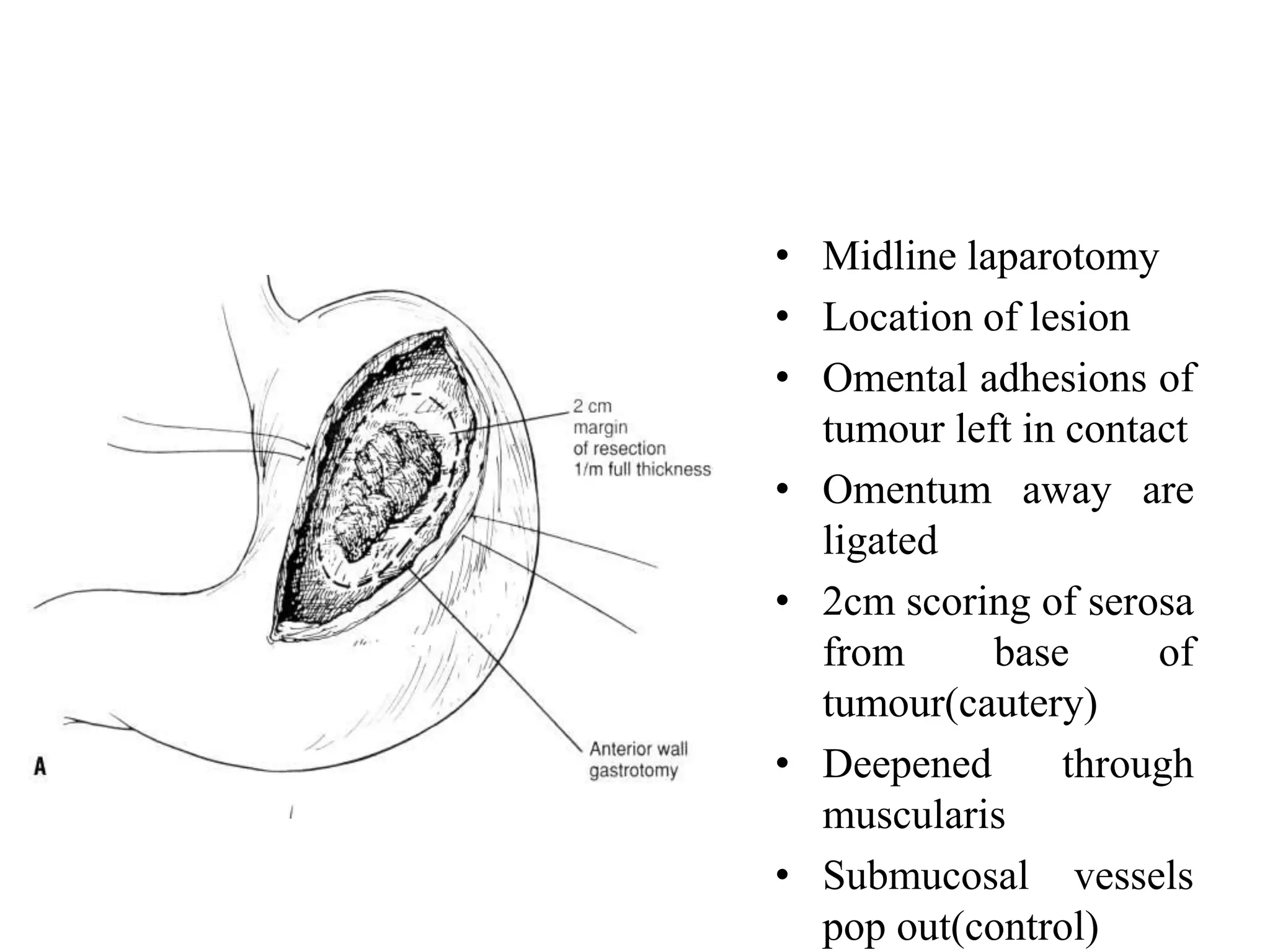 gastrectomy.pptx