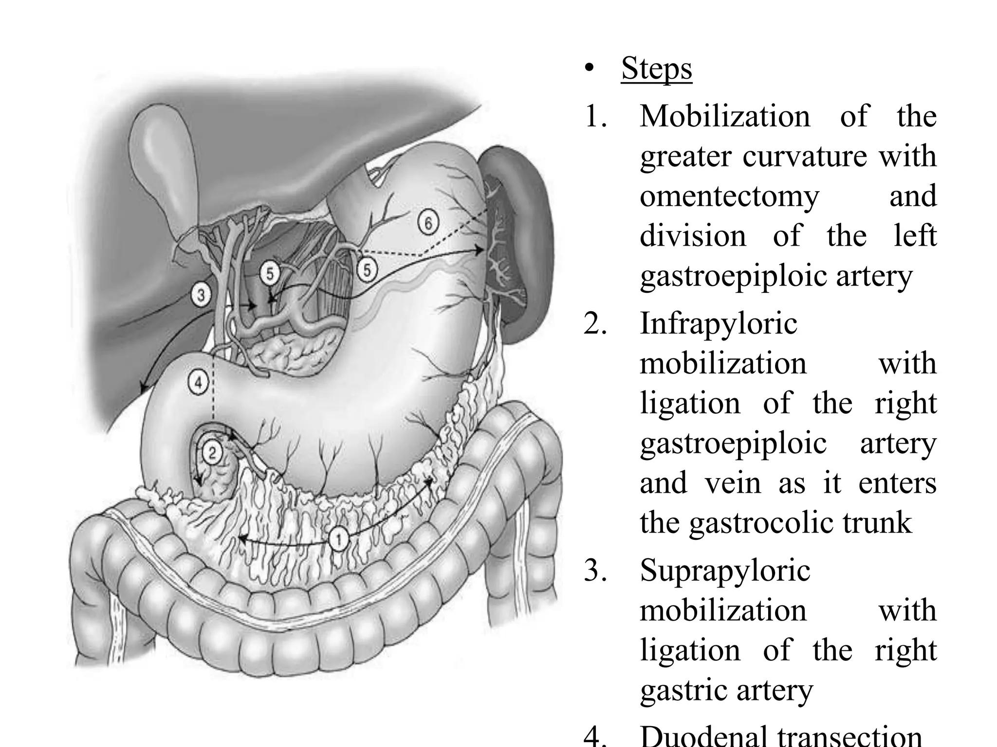 gastrectomy.pptx
