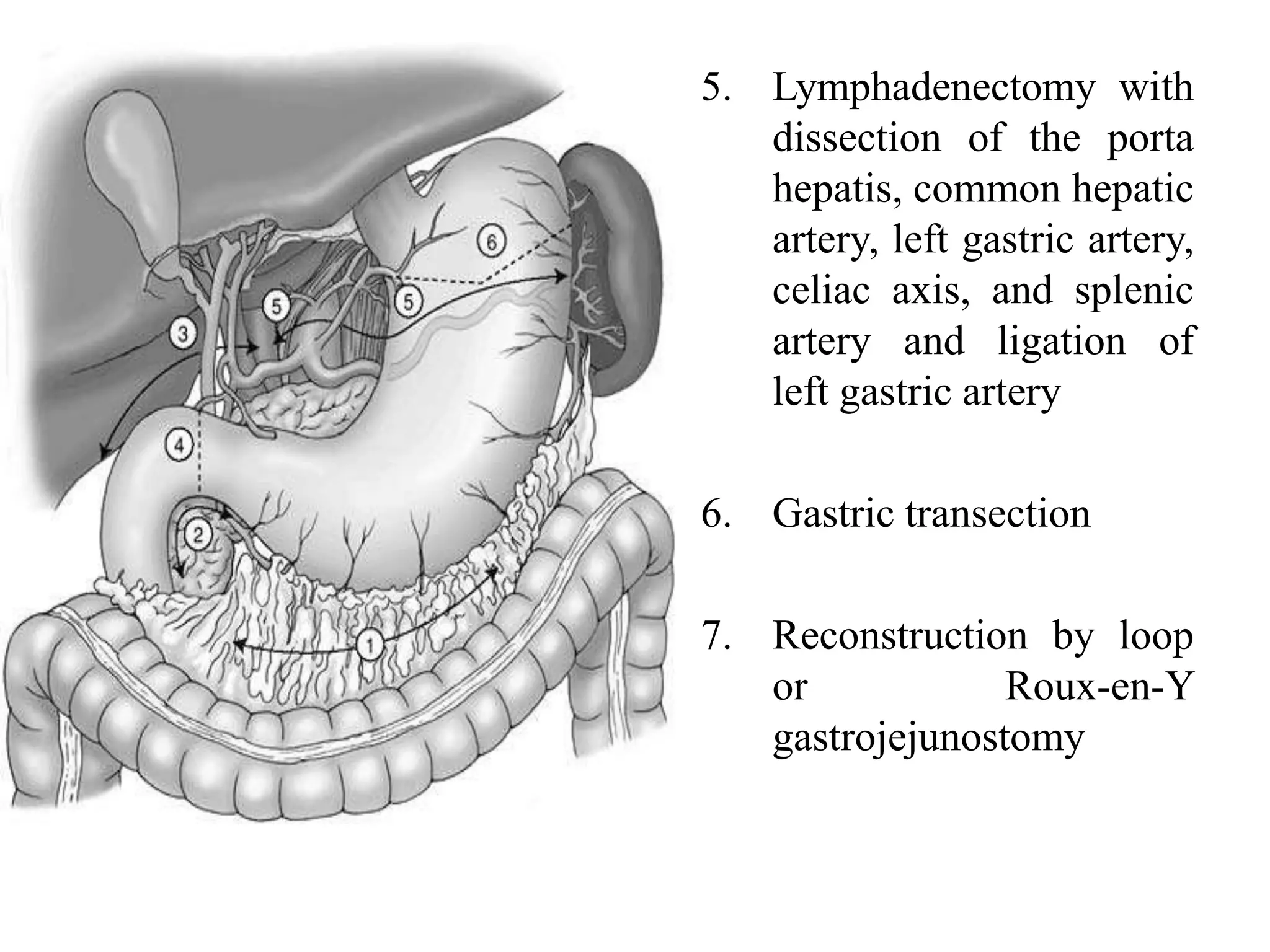 gastrectomy.pptx
