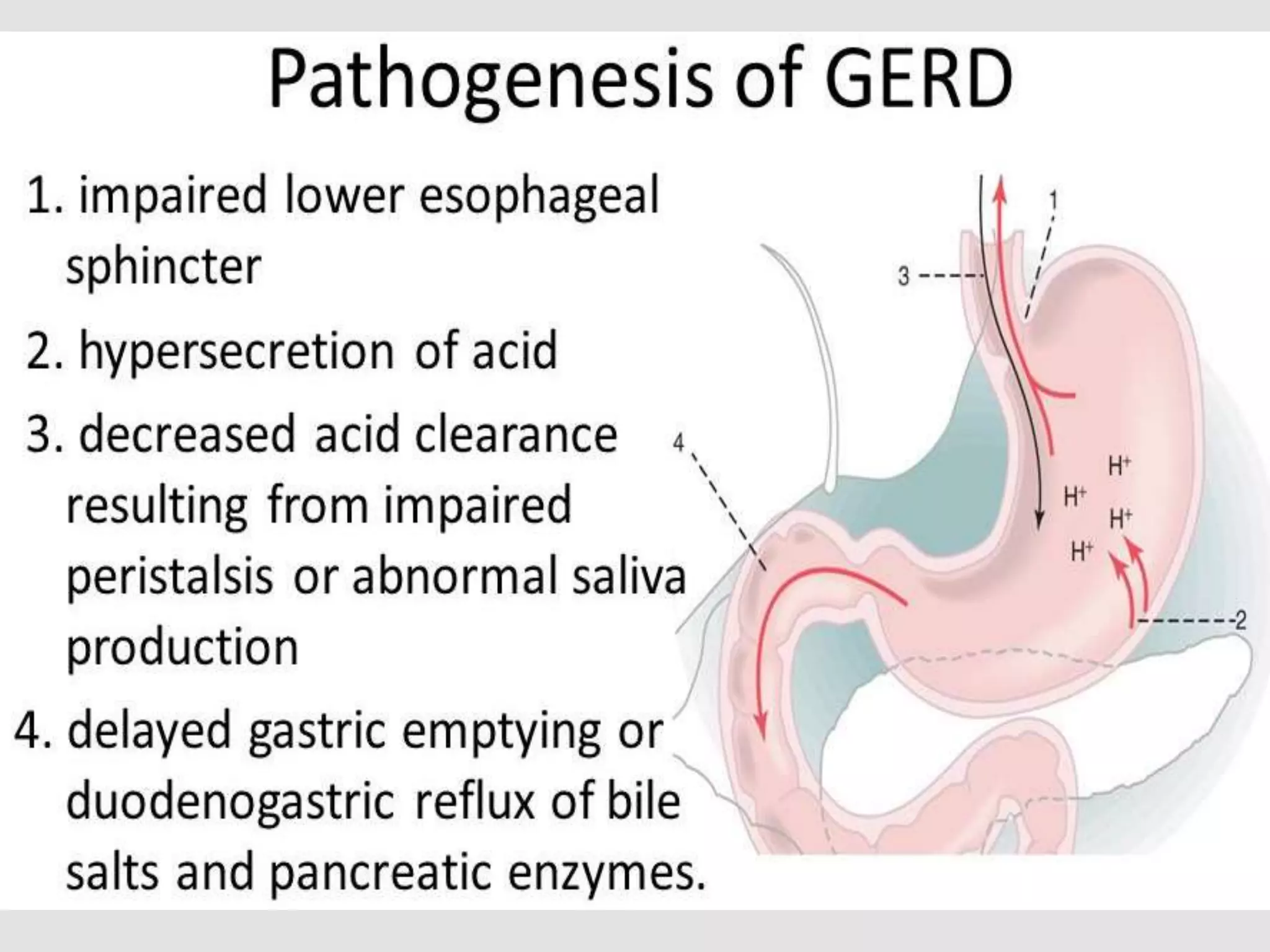 PHARMACOTHERAPY OF Gastric-oesophagal reflux disease [GERD] | PPTX
