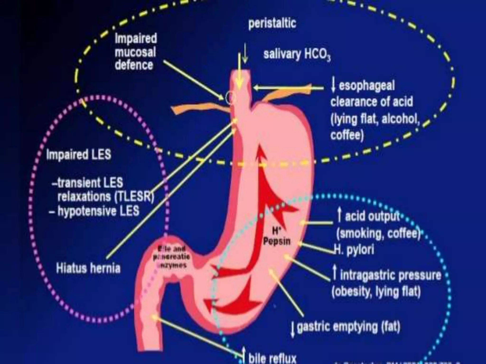 PHARMACOTHERAPY OF Gastric-oesophagal reflux disease [GERD] | PPTX