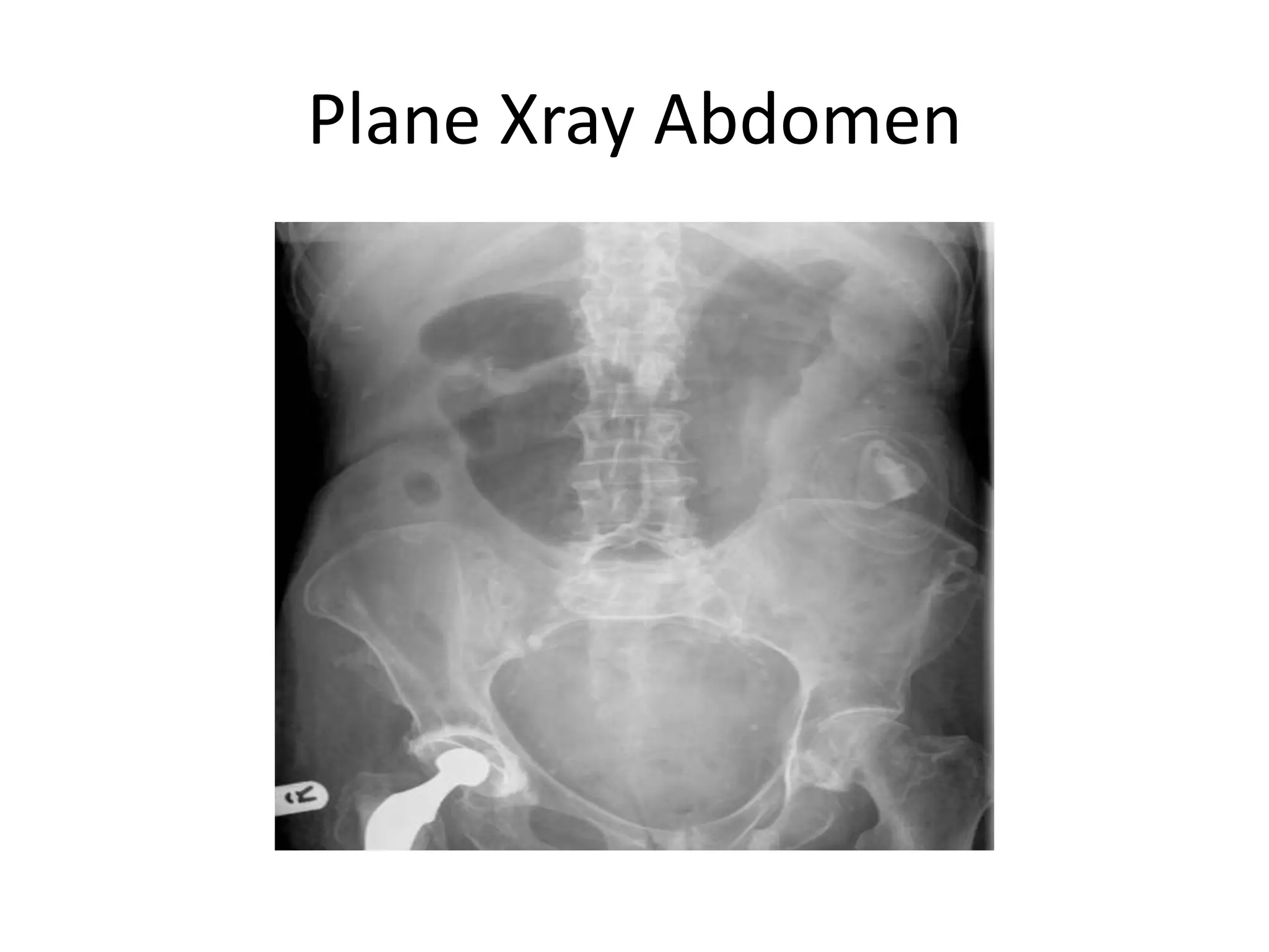 Gastric-Outlet-Obstruction-and-Its-Surgical-Management-Lecture-by-Prof ...
