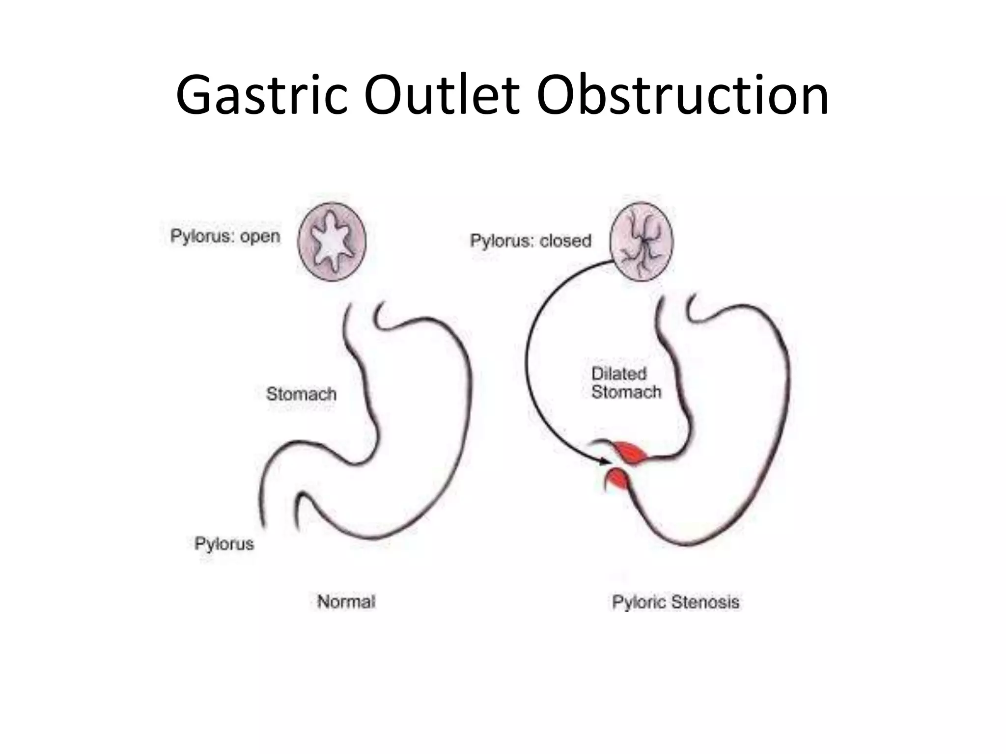 Gastric-Outlet-Obstruction-and-Its-Surgical-Management-Lecture-by-Prof ...