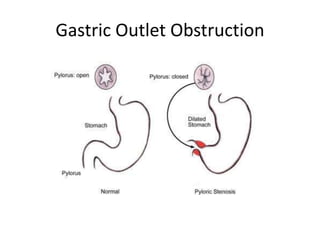 Gastric-Outlet-Obstruction-and-Its-Surgical-Management-Lecture-by-Prof ...