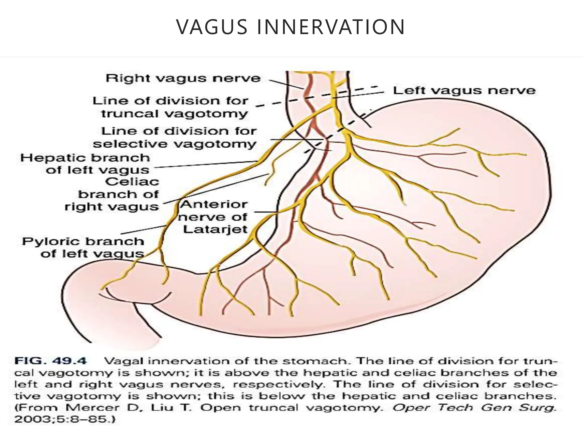GASTRIC PERFORATION general surgery.pptx