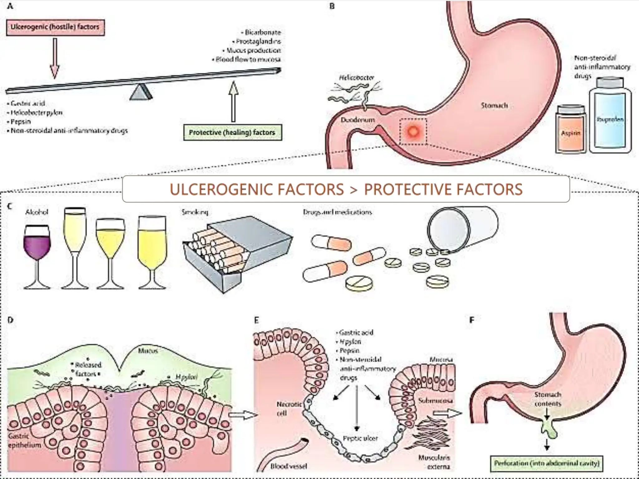 GASTRIC PERFORATION general surgery.pptx