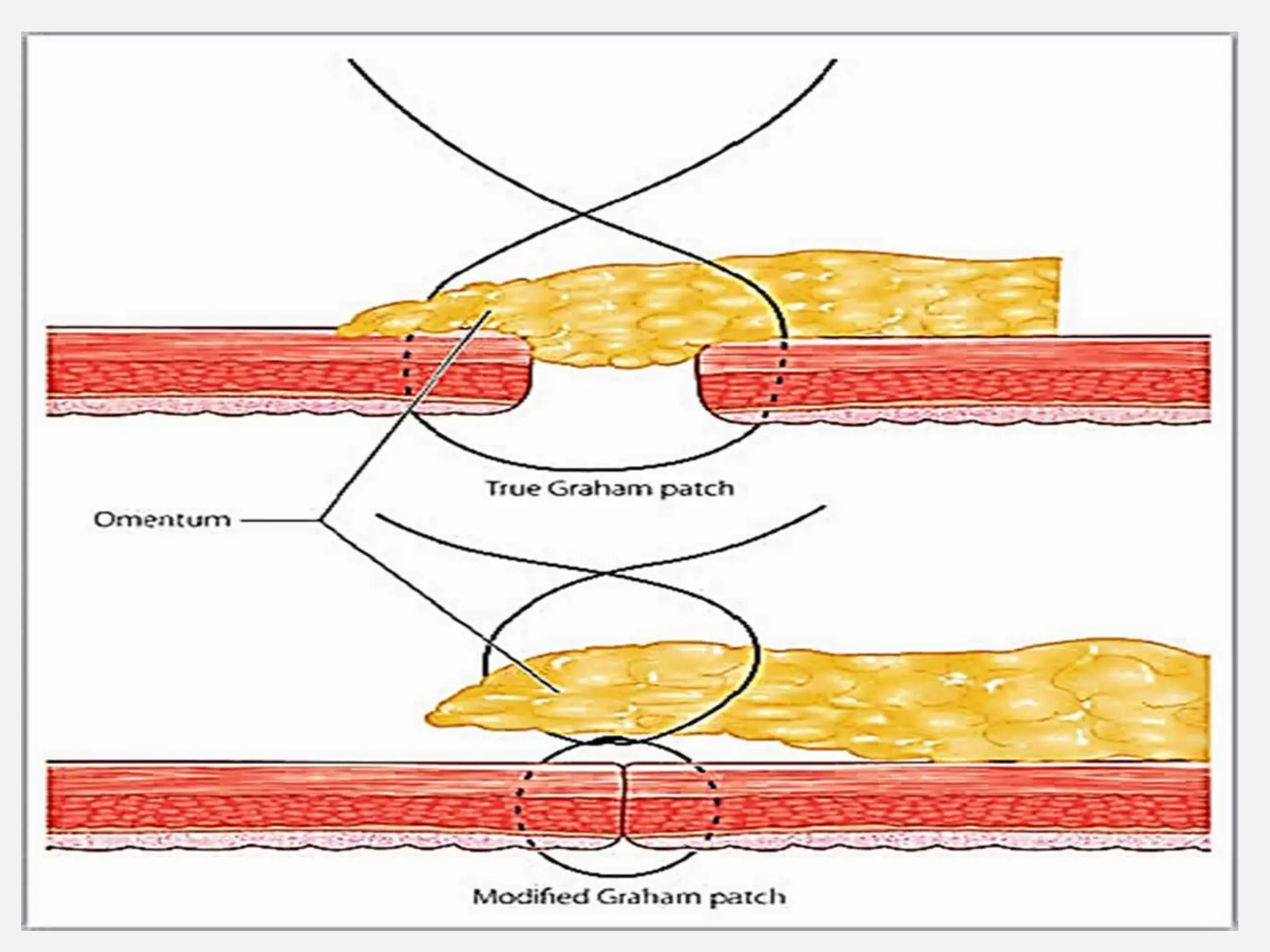 GASTRIC PERFORATION general surgery.pptx