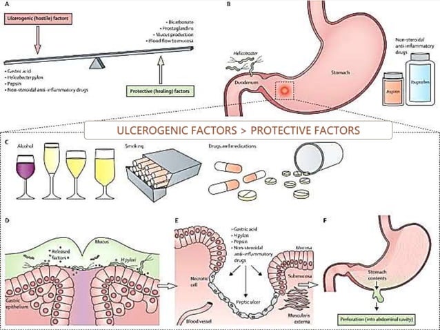 GASTRIC PERFORATION: A BRIEF SURGICAL MANAGEMNT | PPTX | Digestive ...