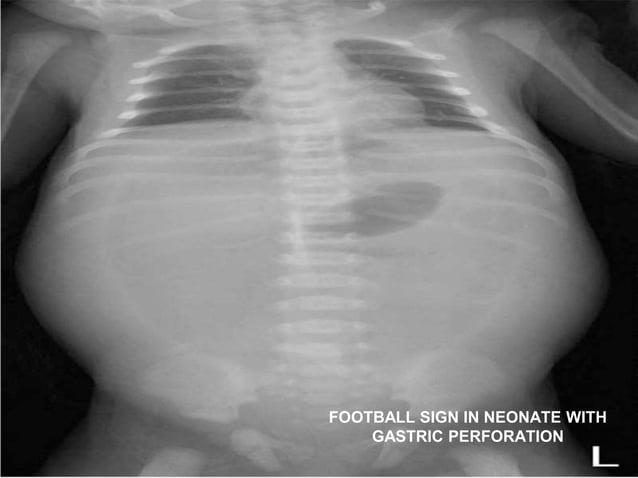 GASTRIC PERFORATION general surgery.pptx