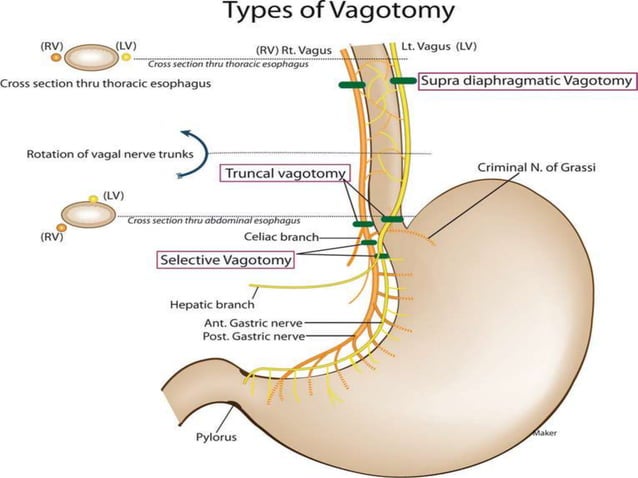 GASTRIC PERFORATION general surgery.pptx