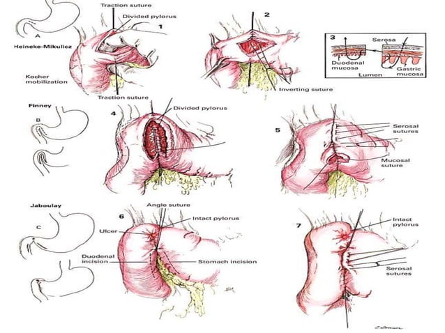 GASTRIC PERFORATION general surgery.pptx