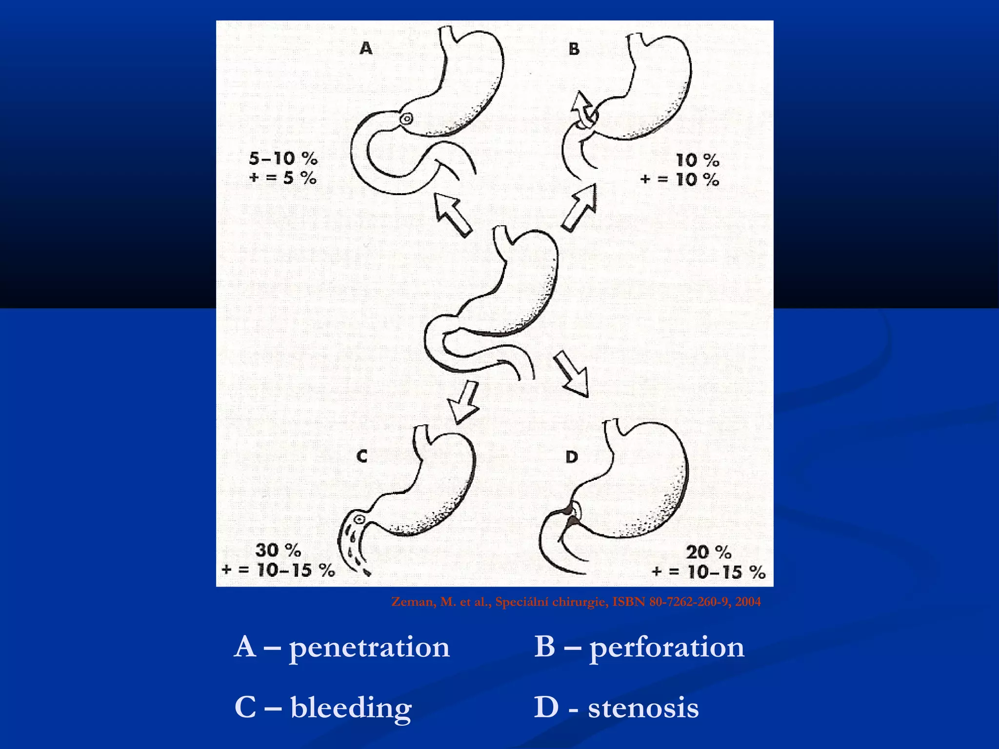 Gastric and duodenal ulcer | PPT