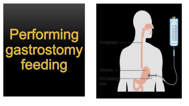 gastric_aspiration,_gastric_analysis_and_gastrostomy_feeding.pptx | Ear ...