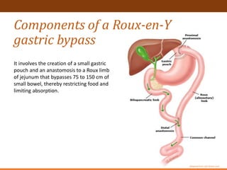Roux En Y Gastrojejunostomy Complications Roux En Y Gastrojejunostomy Complications