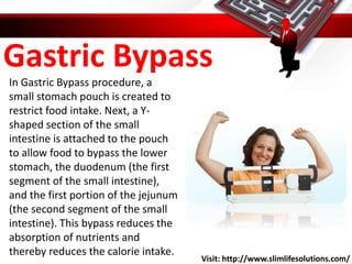 Gastric bypass part i | PPT