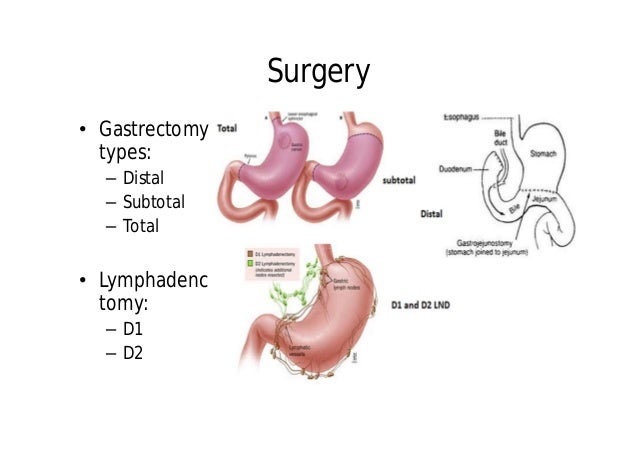Total Gastrectomy Anatomy