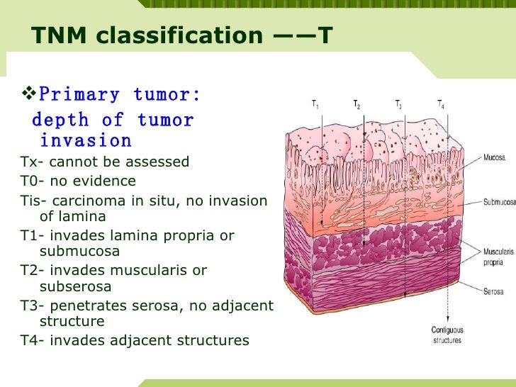 Gastric cancer