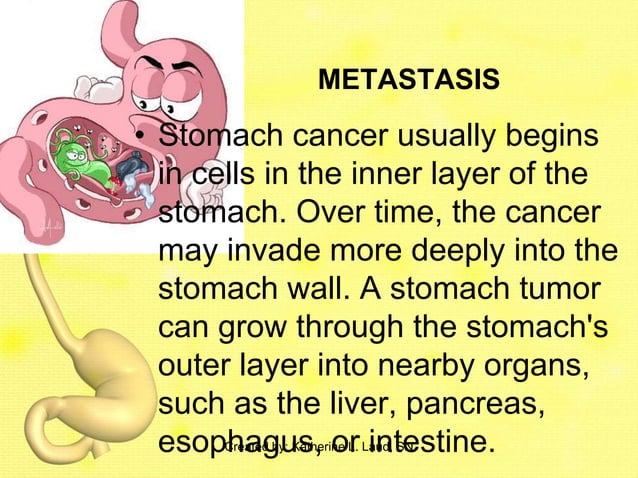 Gastric Cancer PPT | PPTX