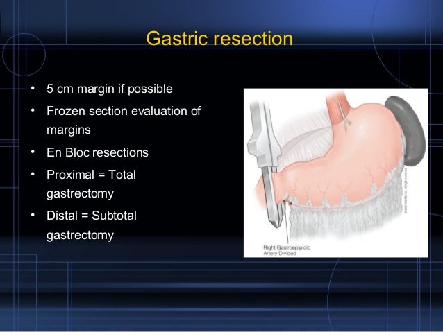 Gastric cancer