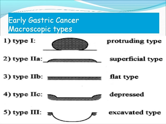 Gastric Cancer Types