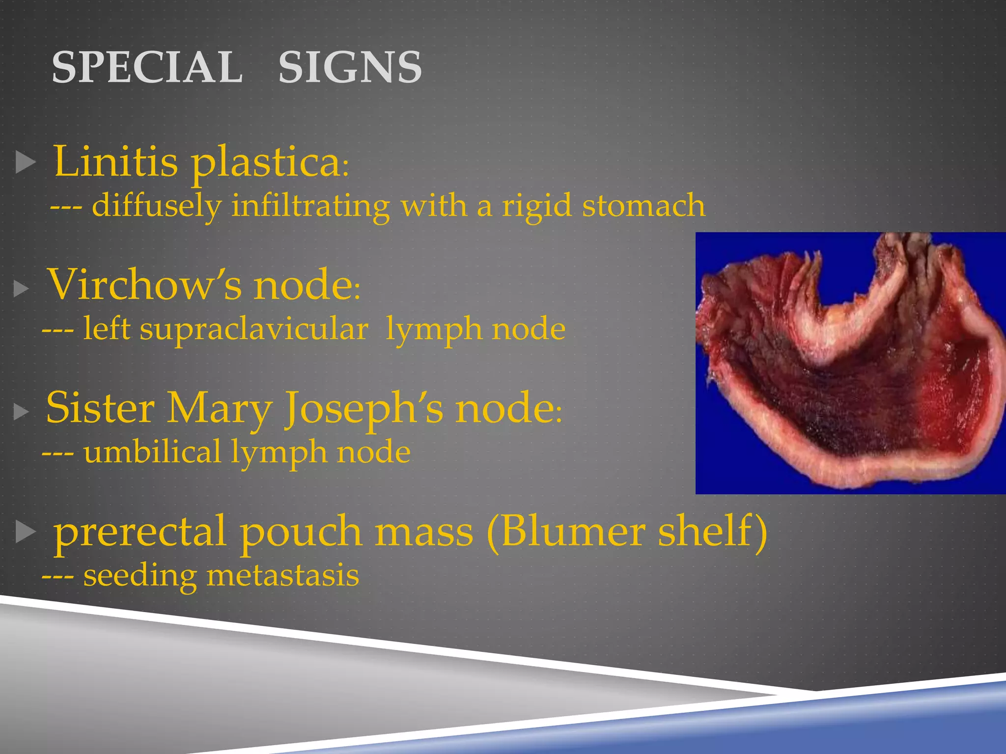 Gastric Cancer ( stomach tumor ) | PPTX