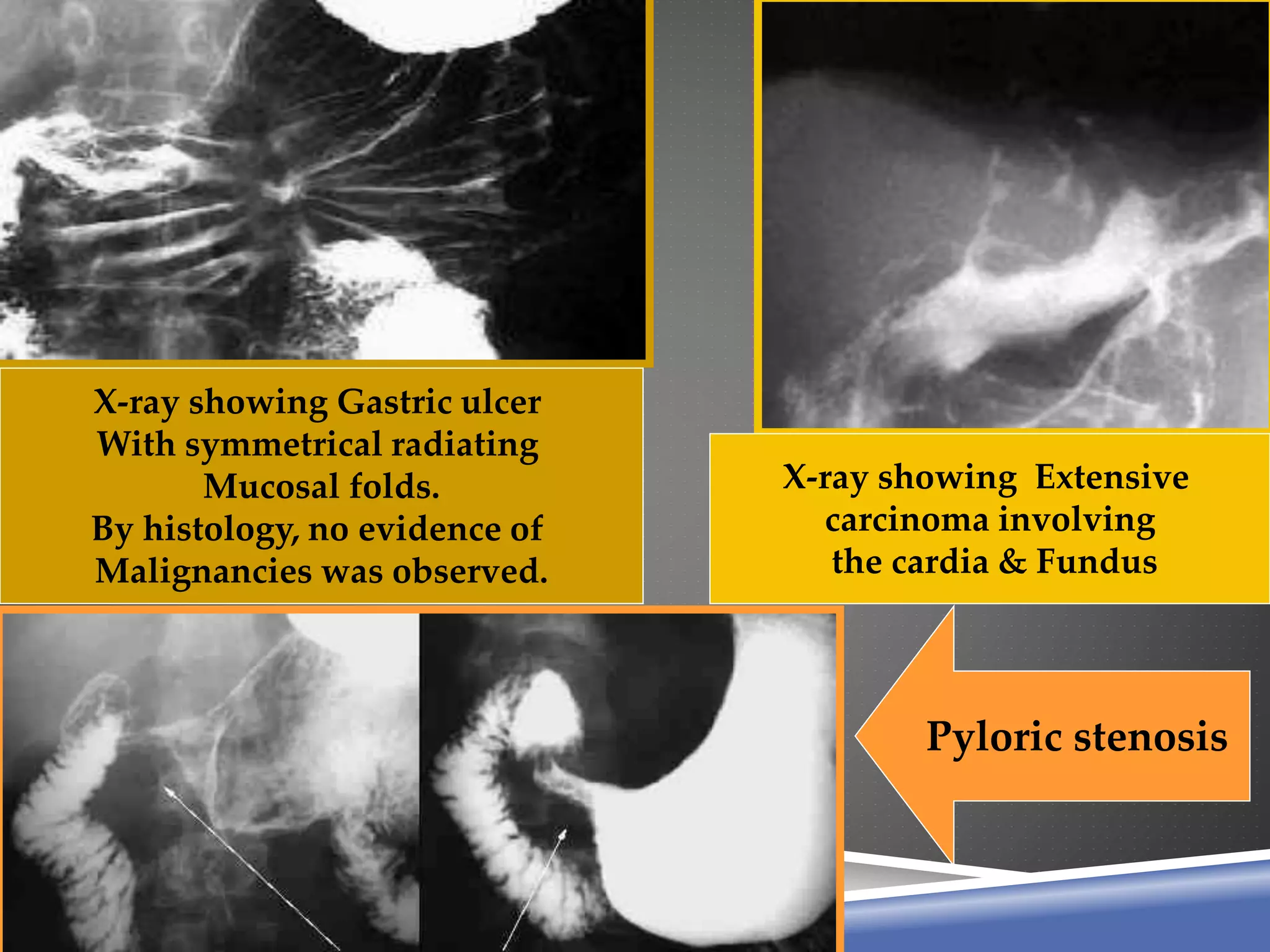Gastric Cancer ( stomach tumor ) | PPTX