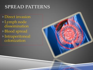 Gastric Cancer ( stomach tumor ) | PPTX