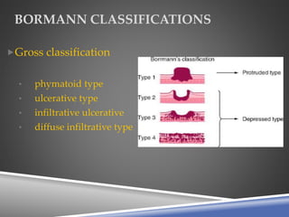 Gastric Cancer ( stomach tumor ) | PPTX