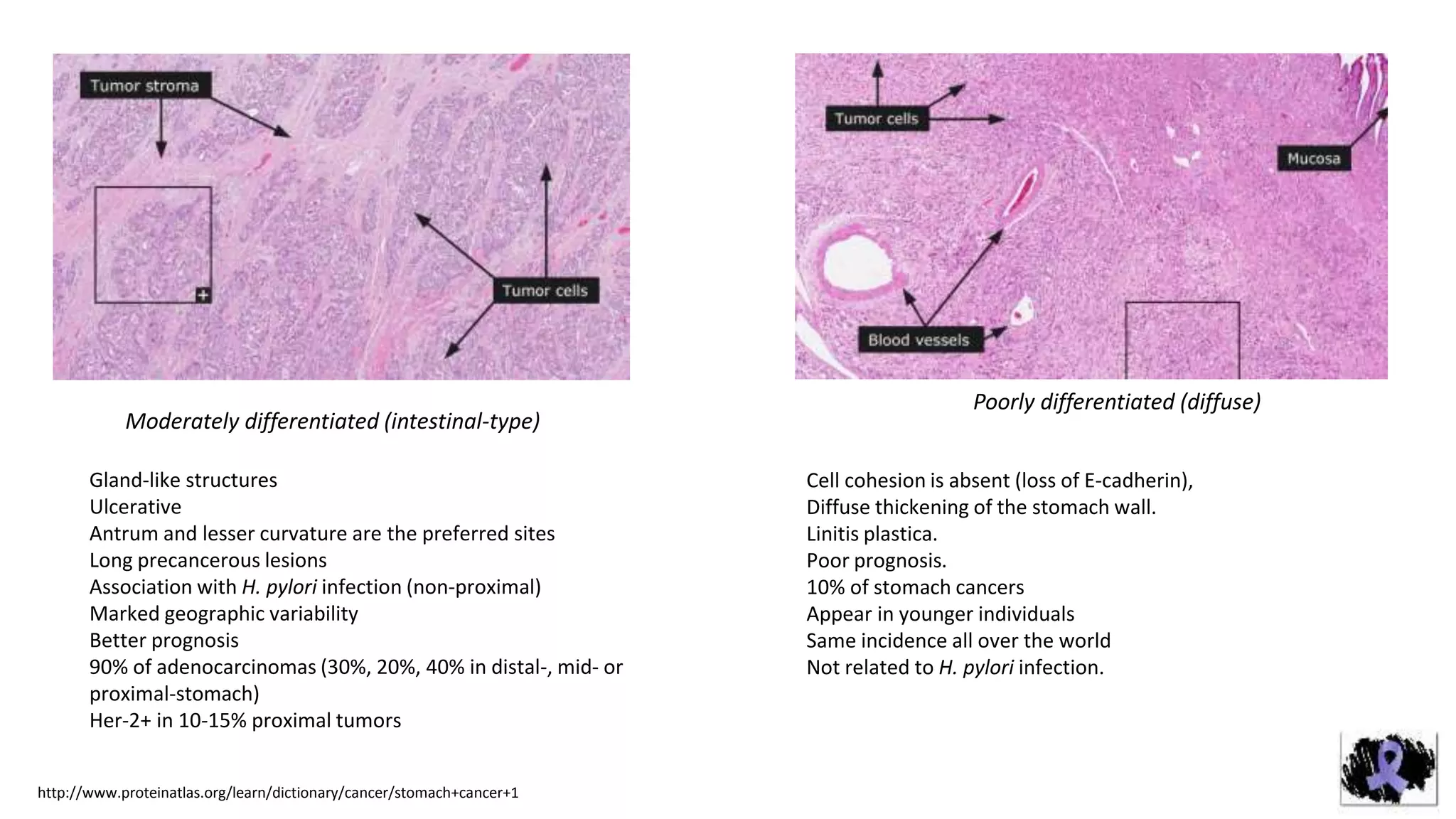 CES2016-02: Gastric cancer | PPTX
