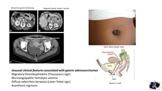 CES2016-02: Gastric cancer | PPTX