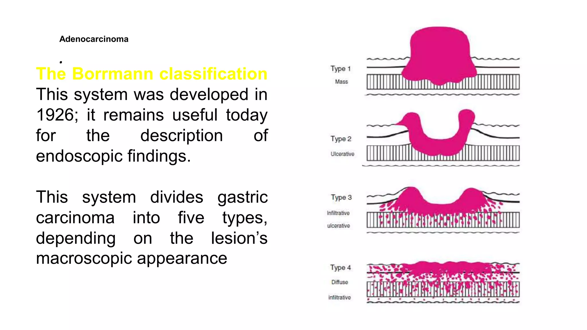 Gastric cancer | PPTX